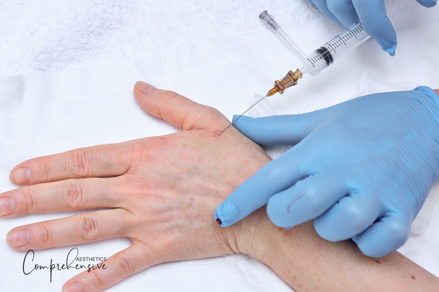 PRP Hand Rejuvenation Treatment: Restore Smooth, Youthful Skin ...